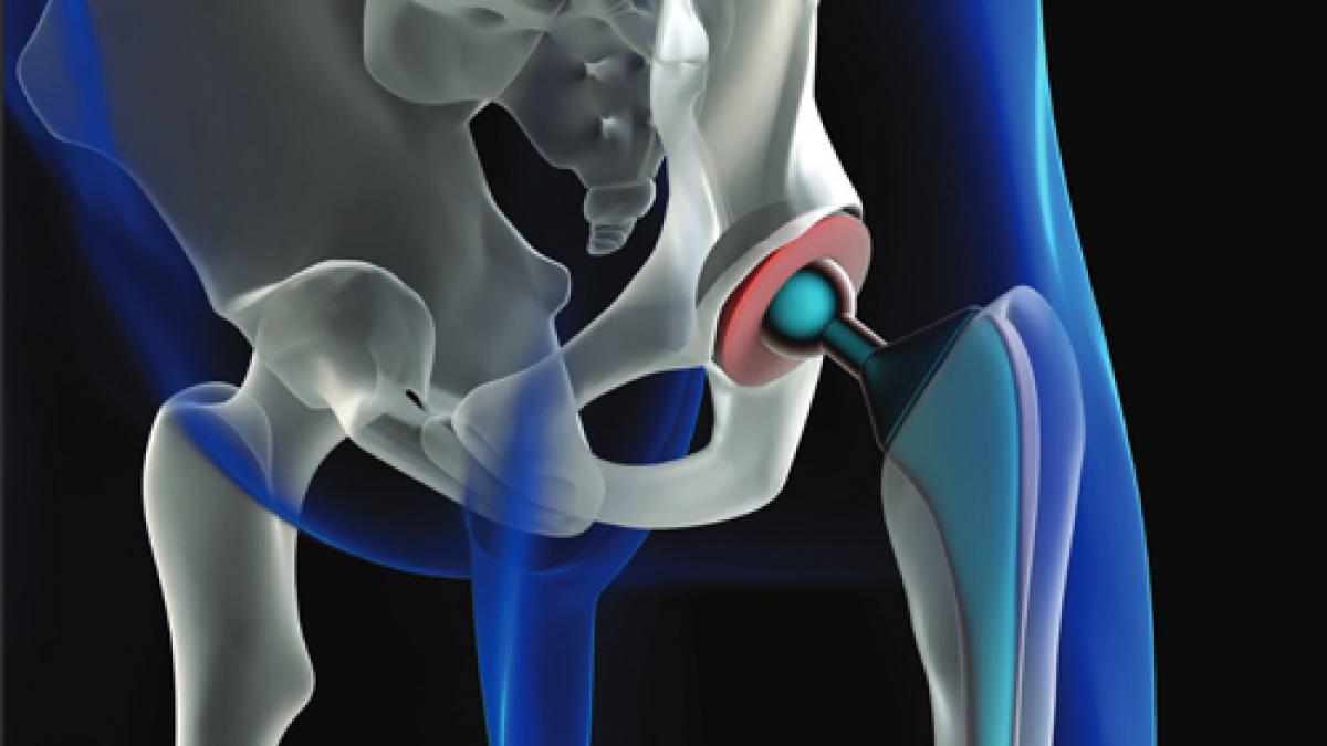 60% of hip fracture patients don’t get early MDT care, audit finds ...